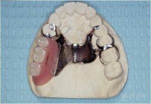 Case 1: Maxillary Implant-Supported and Retained Removable Partial ...