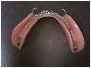 Case 4: Mandibular Implant-Supported and Retained Removable Partial ...