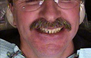 Onlay Ramus Block Bone Grafting | Prosthodontist Overland Park, KS