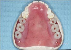Case 1: Maxillary Implant-Supported and Retained Removable Partial ...