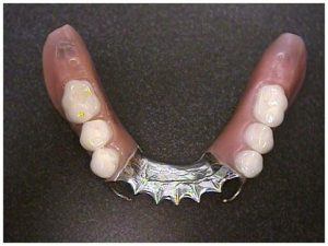 Case 4: Mandibular Implant-Supported and Retained Removable Partial ...