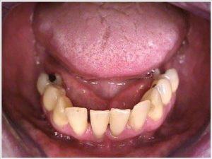 Onlay Ramus Block Bone Grafting | Prosthodontist Overland Park, KS