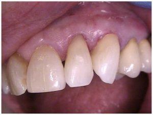 F Class V Abfraction Restorations | Prosthodontist Overland Park, KS