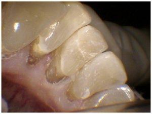 L Class V Abfraction Restorations | Prosthodontist Overland Park, KS