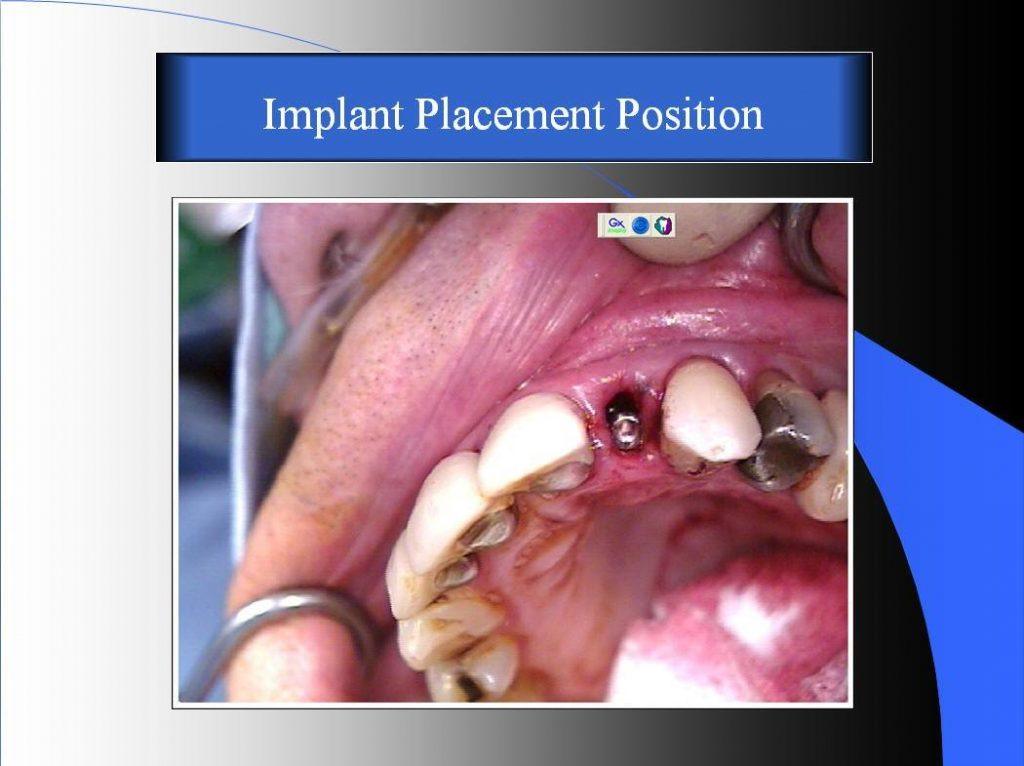 Benex Extraction With Immediate Implant Placement Using A Precision ...
