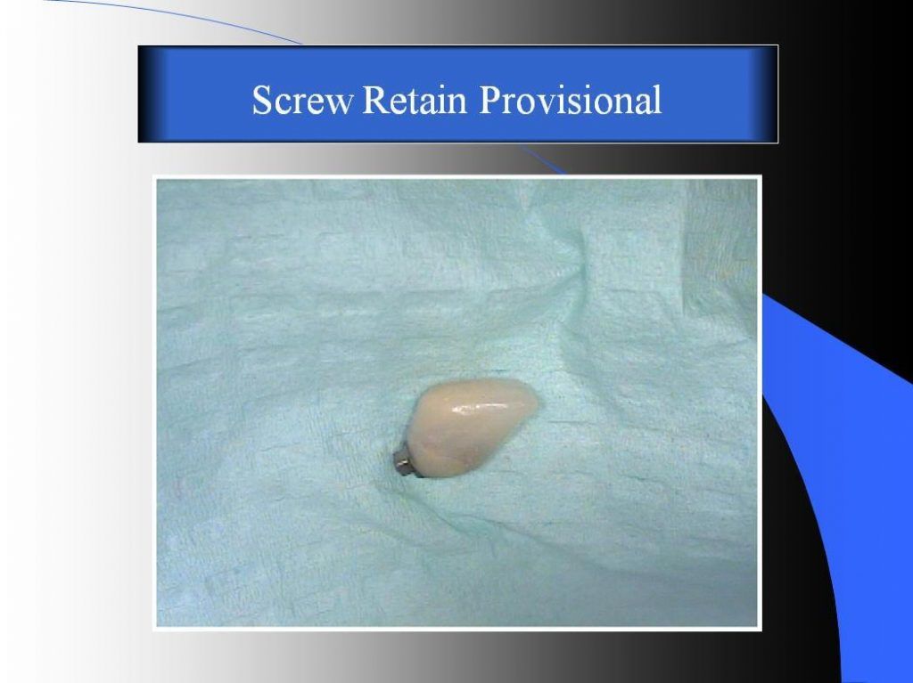 Benex® Extraction with Immediate Implant Placement, Using a Precision ...