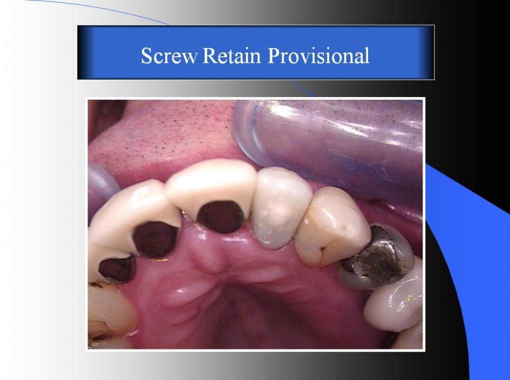 Benex® Extraction with Immediate Implant Placement, Using a Precision ...