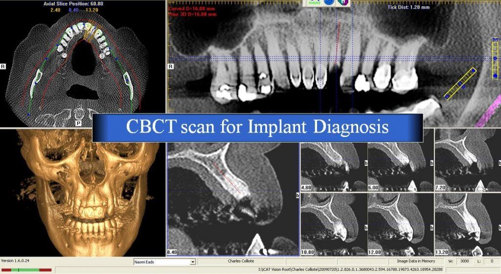 Benex® Extraction with Immediate Implant Placement, Using a Precision ...