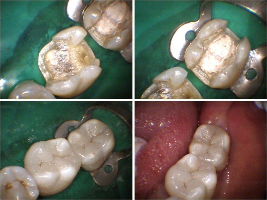 Ceramic Inlays | Prosthodontist Overland Park, KS